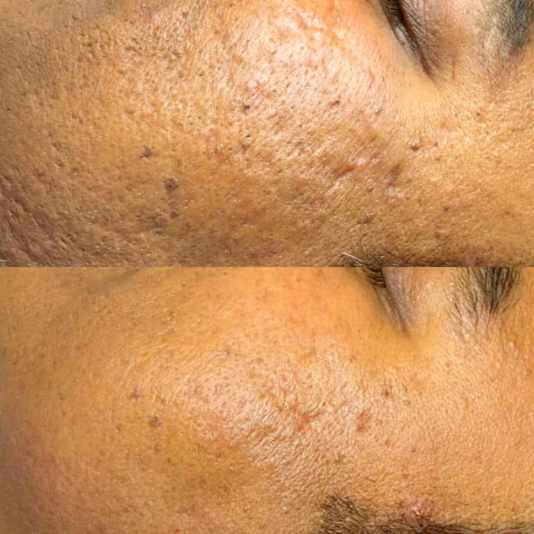 Tetra Co2 Laser Cool Peel At Enriched Vaughan