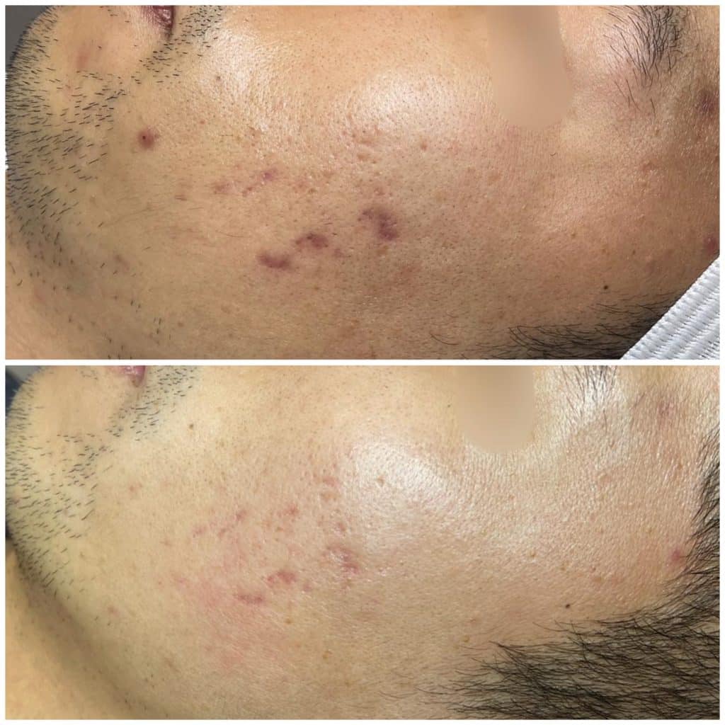 Vaughan Herbs2Peel Chemical Peel | Cosmetic injections Vaughan