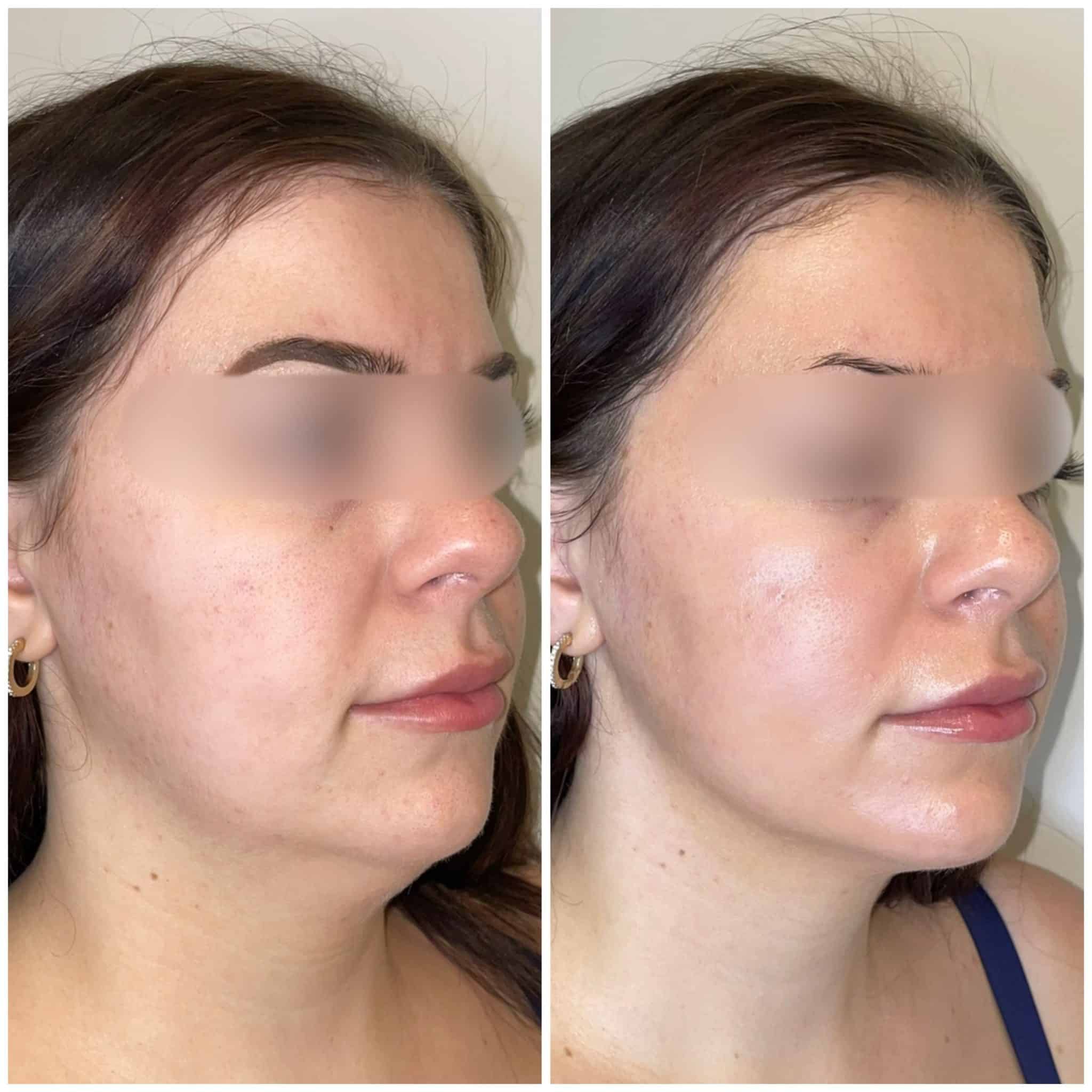 Radiofrequency | TriPollar | Skin Tightening | Vaughan | Woodbridge ...