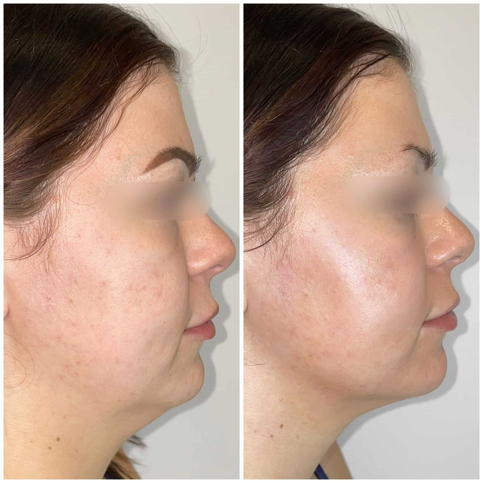 Radiofrequency | TriPollar | Skin Tightening | Vaughan | Woodbridge ...