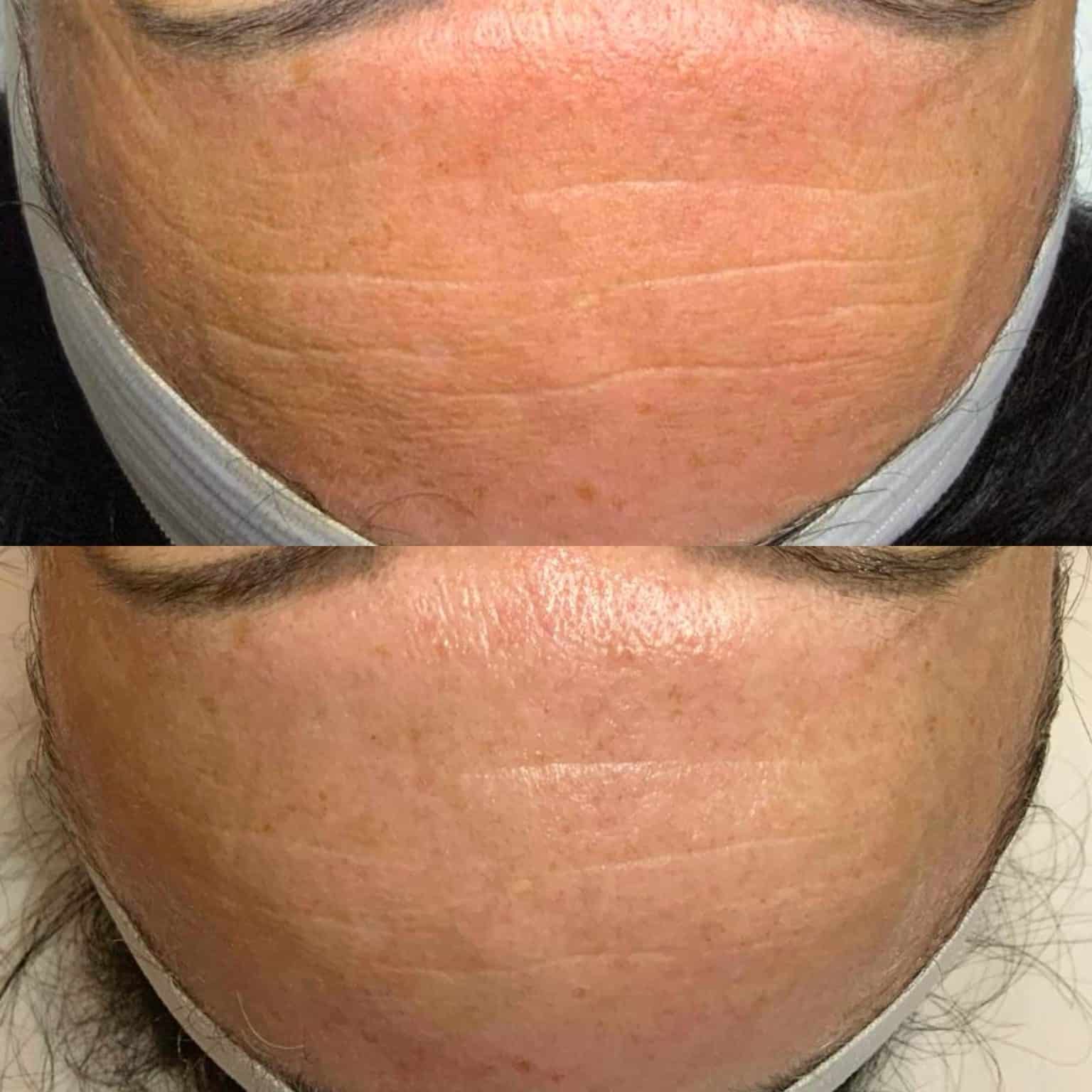 Tetra Co2 Laser Cool Peel At Enriched Vaughan