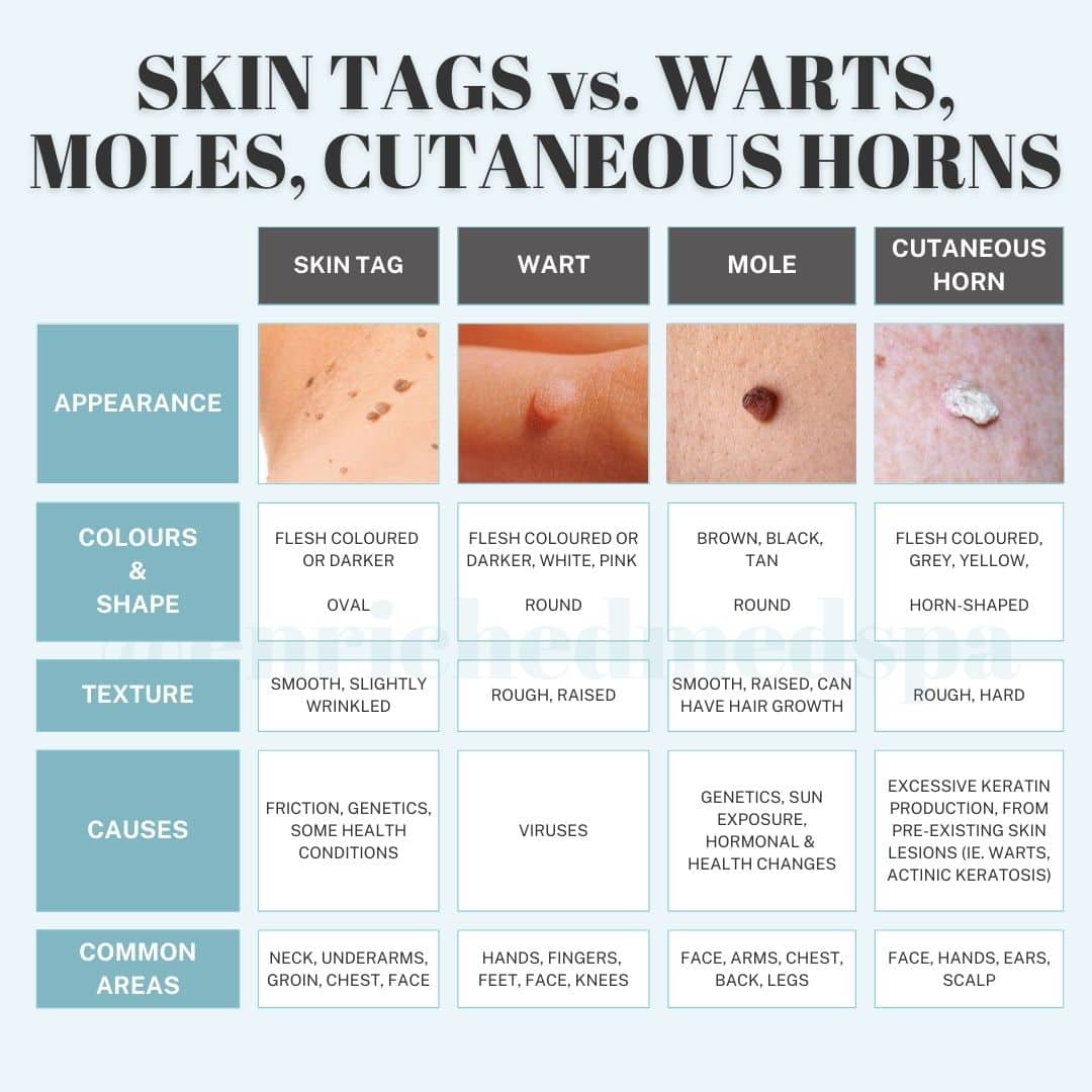 Skin Tag Removal - Botox Laser Hair Removal OxyGeneo Medi Facial ...